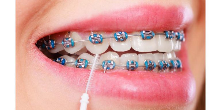 Cómo cepillarse los dientes con brackets | Dental Company
