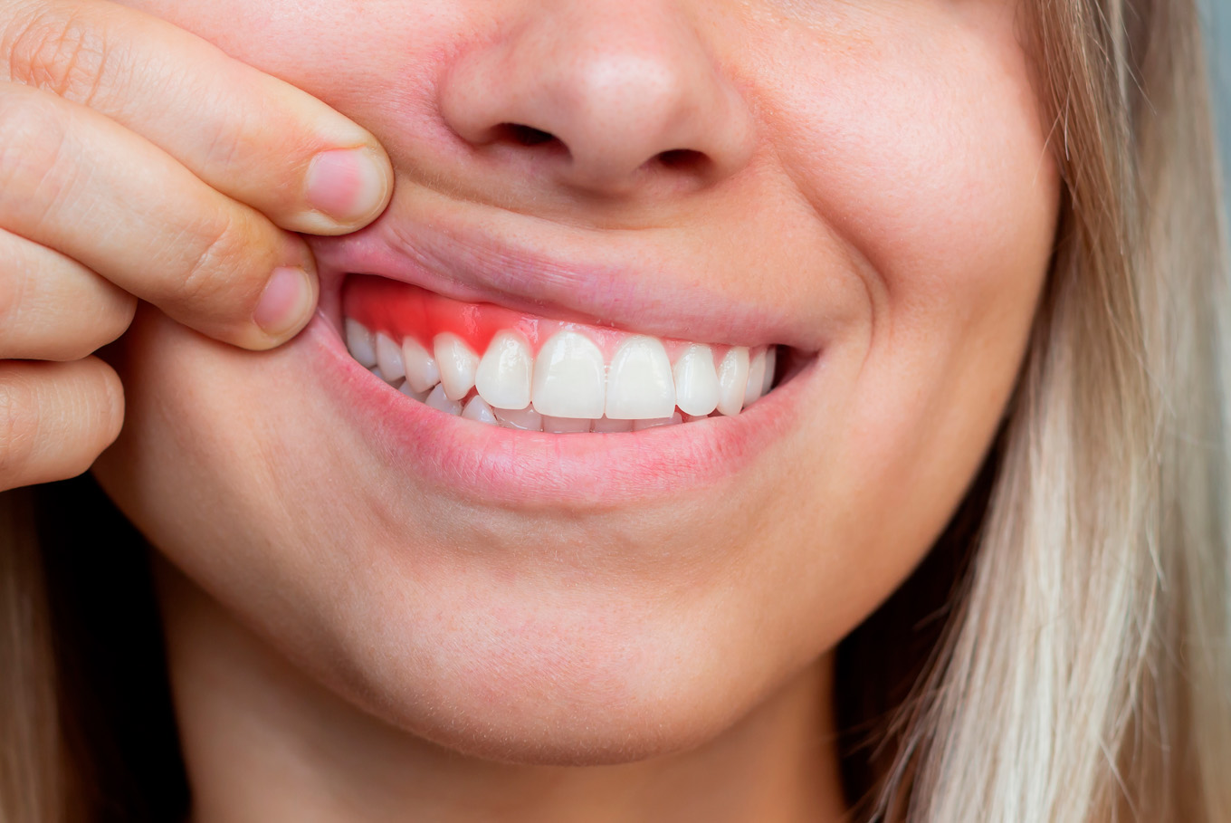 Periodontitis Avanzada: Síntomas y Tratamientos Eficaces | Dental Company