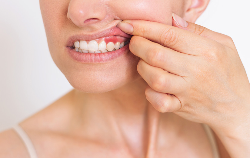 Fístula dental: por qué aparece y cómo tratarla | Dental Company